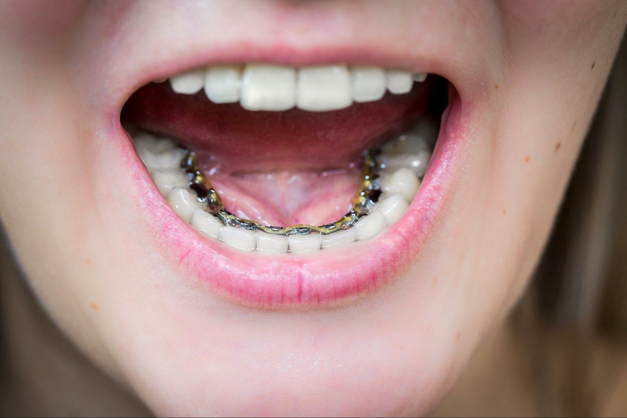 Lingual Braces Vs Invisalign Which One Is Right For You 